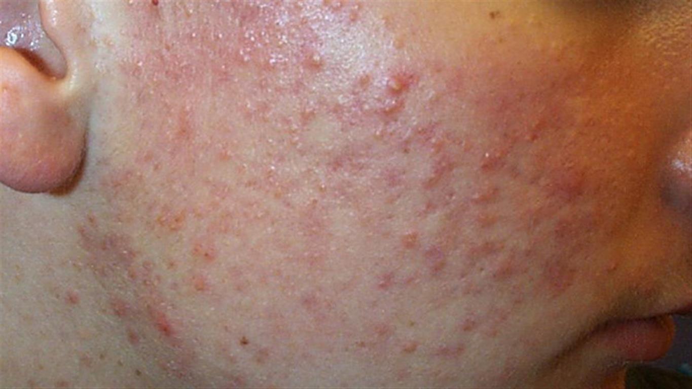 Pimples Popping Your Social Life Here s The Lowdown On Acne Review Pimples Popping Your Social Life Here s The Lowdown On Acne Review